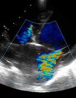Ultraljud - Blå Stjärnan Borås